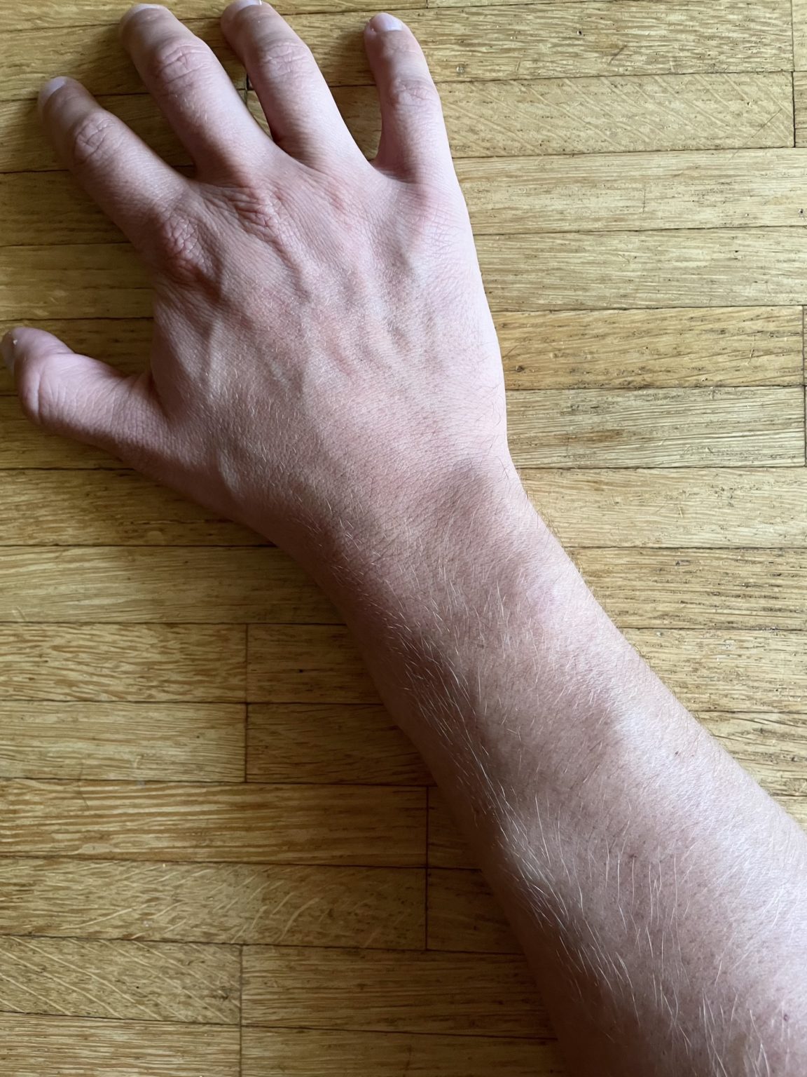 Lipome erkennen - Anzeichen & Diagnose - lipome.net