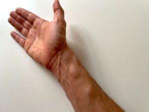 Lipome in Bildern – Wie sieht ein Lipom aus?