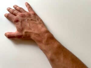 Lipome in Bildern – Wie sieht ein Lipom aus?