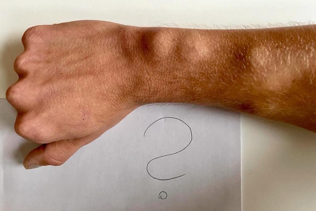 Lipome am ganzen Körper, was sollte man tun? - lipome.net